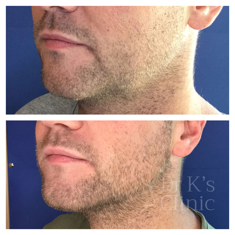 Aqualyx Fat Dissolving Treatment in Wrexham